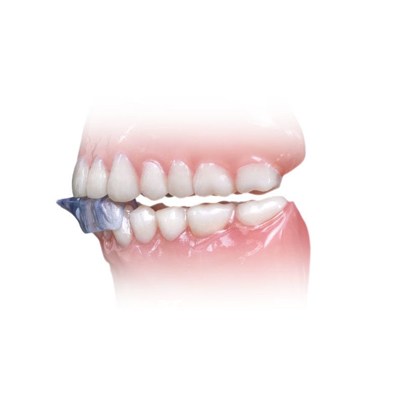 Bite dentale anti-bruxismo - NTI-tss Plus® - Glidewell Europe