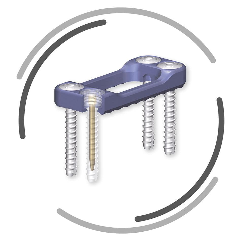 Placca per artrodesi toraco-lombare - CONTACT - Signus Medical ...