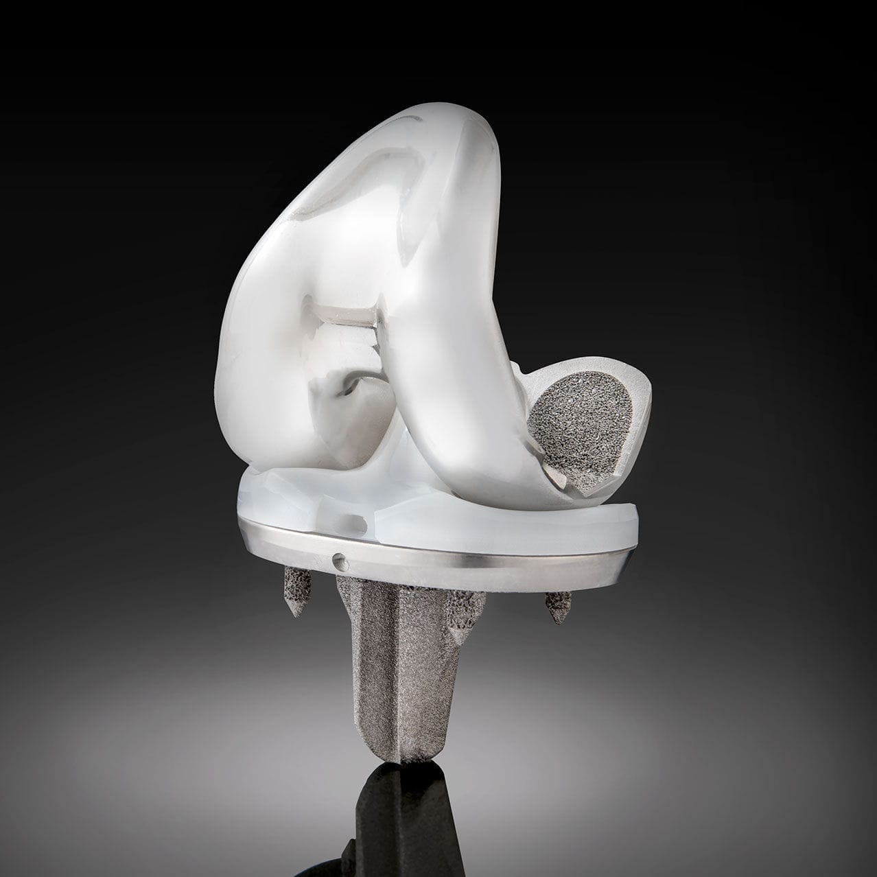 Protesi di ginocchio tricompartimentale - Truliant® Porous - Exactech ...