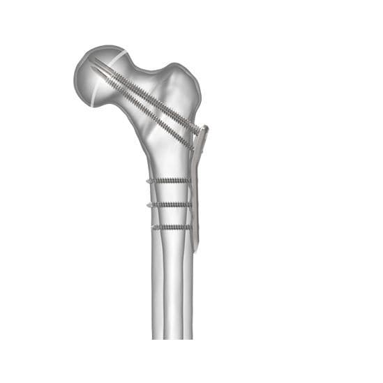 Placca di compressione per testa del femore - 00-0903-3840 ...