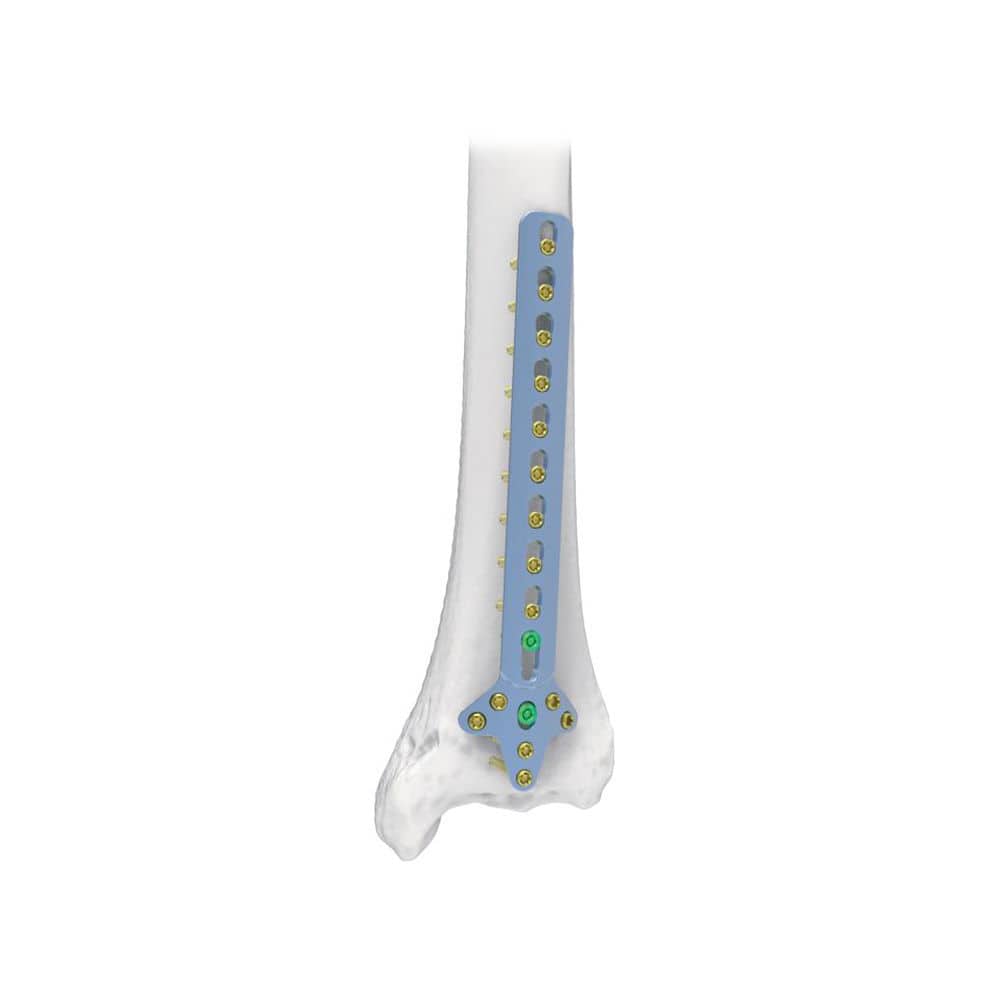 Placca di compressione per omero - NORMMED Medical Devices - distale ...