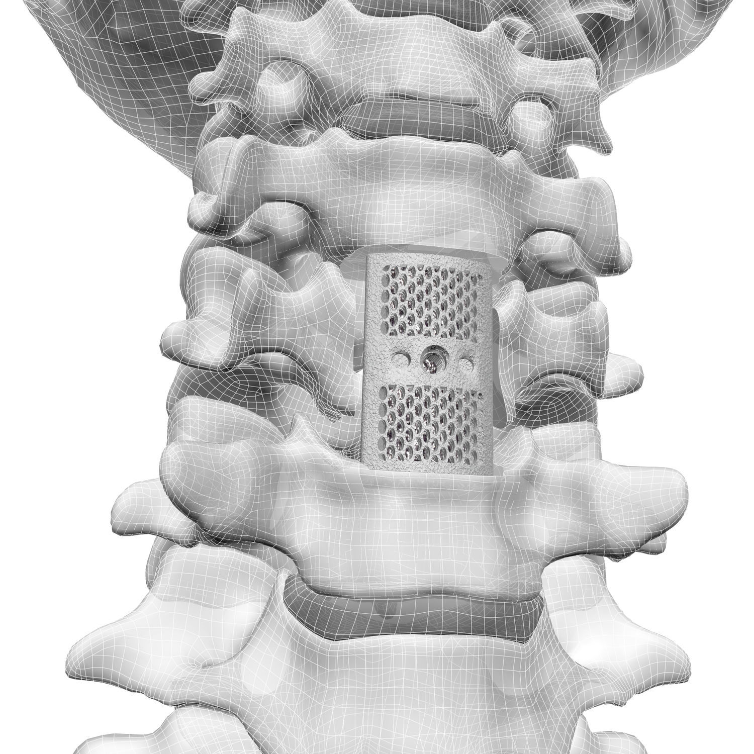 Protesi per corpectomia vertebrale cervicale - F3D - Corelink Surgical ...