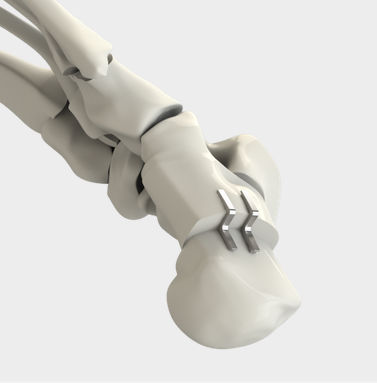 Graffa ortopedica per osteotomia di spostamento del calcagno ...