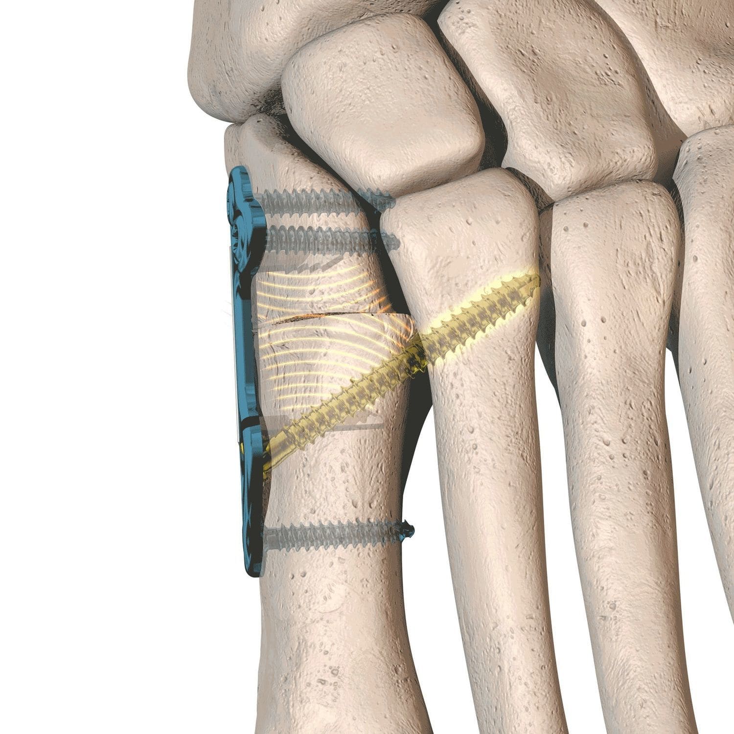 Placca per osteotomia per alluce valgo - dynaBunion® - CrossRoads ...