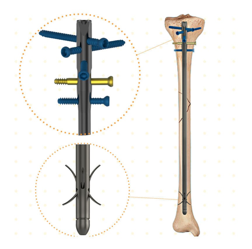 Chiodo intramidollare per tibia - Nite - Dunitech - fissazione ...