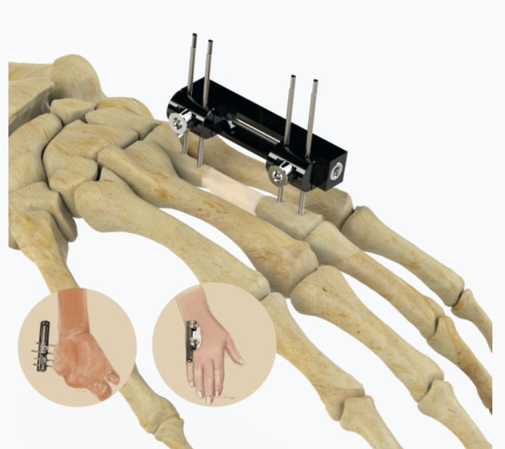 Fissatore esterno per articolazione metacarpo-falangea - 5084 series ...