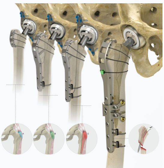 Placca di compressione per femore - Zimed Medical