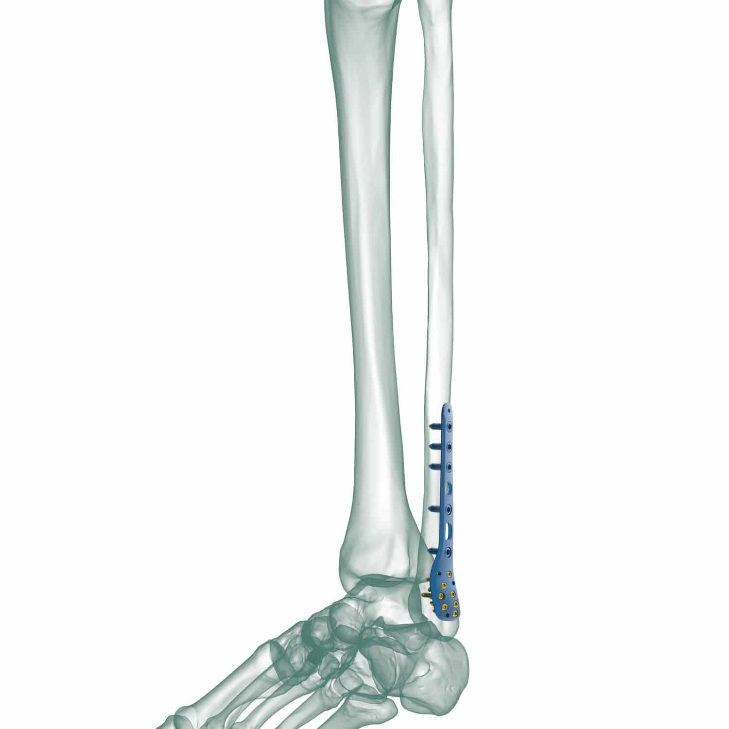 Placca di compressione per fibula - TRUE LOCK Distal Fibula ...