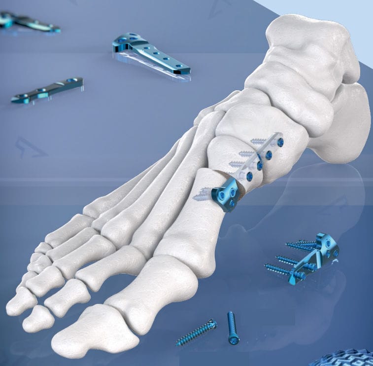 Placca per osteotomia per alluce valgo - A-TEC - AGOMED Medizin-Technik ...