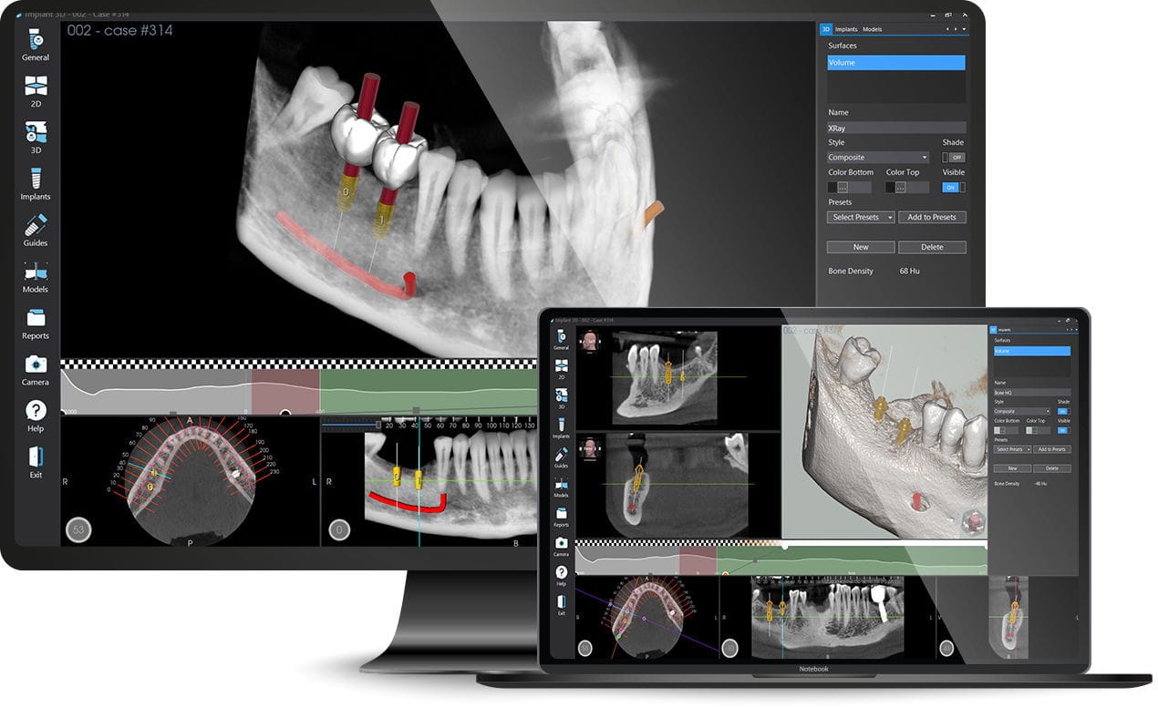 Software di progettazione - Implant 3D - MediaLab - di simulazione 3D / di ispezione / medico