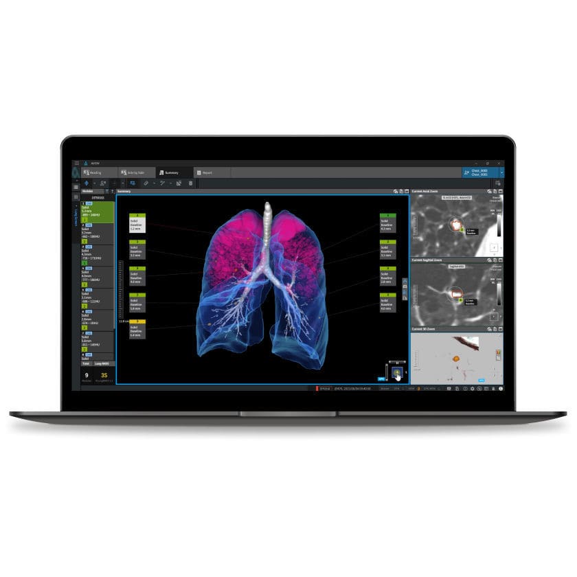 Software per screening del tumore del pomone - LCS - Coreline - di ...
