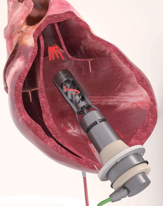 Dispositivo di assistenza ventricolare per adulti - FLOWMAKER ® - FineHeart