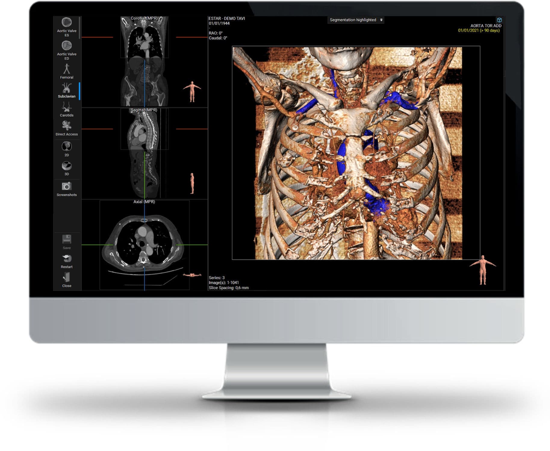 Software di visualizzazione 3D - 3MENSIO - Esaote - di analisi / medico ...