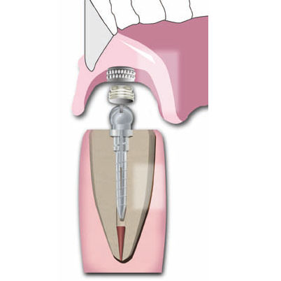Perno radicolare in metallo - Flexi-Overdenture - ESSENTIAL DENTAL SYSTEMS