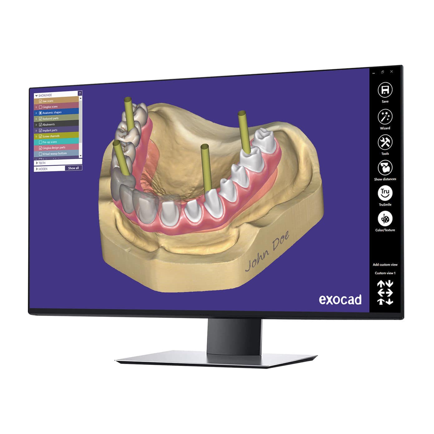 Modulo software di progettazione - Implant - exocad GmbH - CAD / per ...