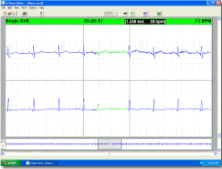 Software di monitoraggio - Trillium Silver™ - Forest Medical - di ...