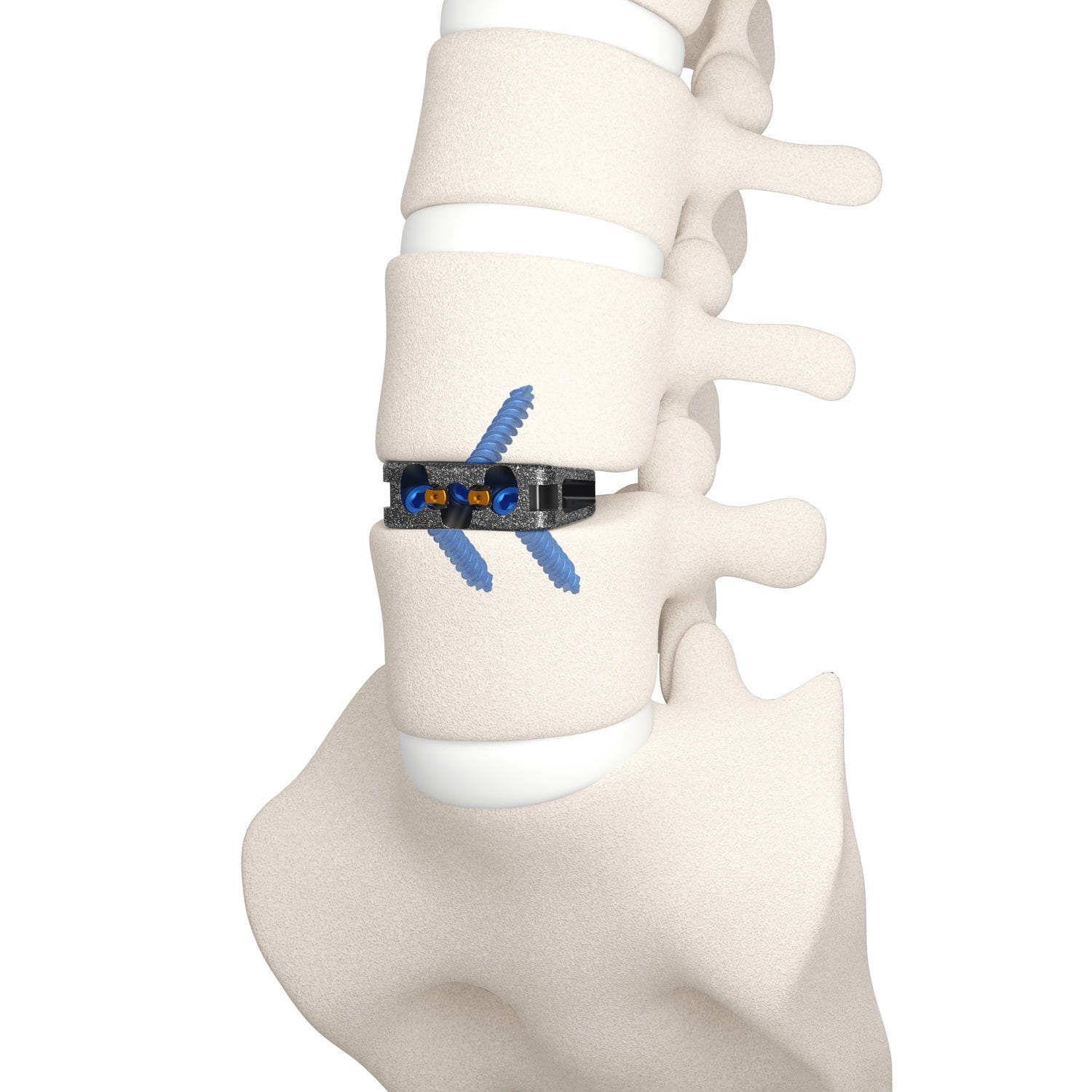 Gabbia intersomatica lombare - DYNA-LINK® - Life Spine - via anteriore ...