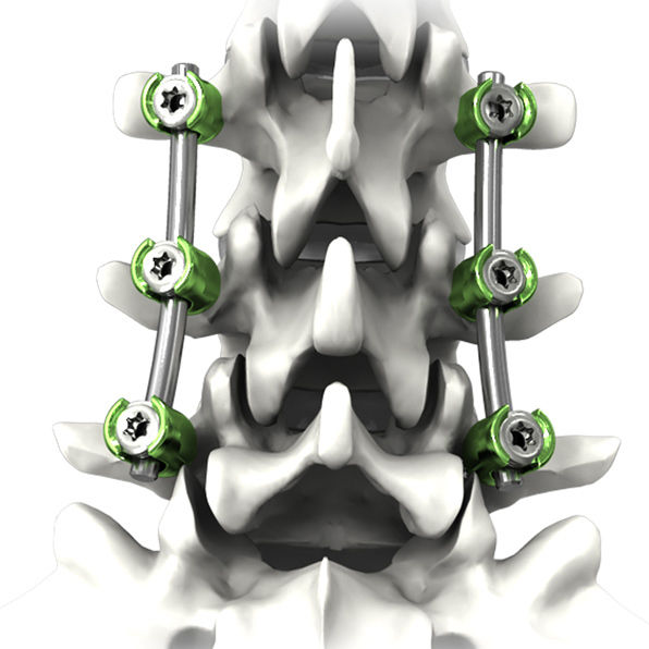 Sistema di osteosintesi toraco-lombare - NAUTILUS® - Life Spine - via ...