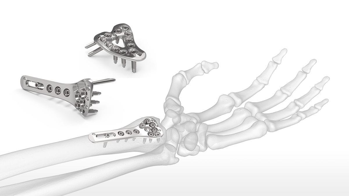 Placca di compressione per radio - ExtremiLock™ - Acumed - per polso ...