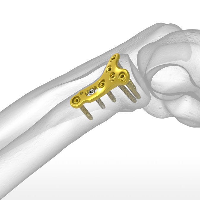 Placca di compressione per capo radiale - 70-0098 - Acumed - distale ...