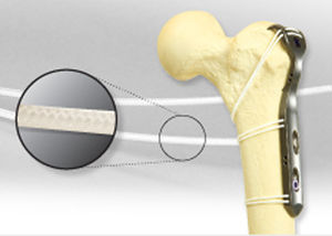 Protesi femoro-rotulea - KineMatch® - Kinamed