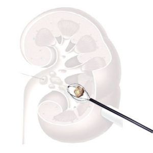 Cestello endoscopico per estrazione di calcolo renale - PerkX - ROCAMED ...