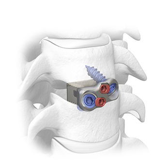 Gabbia intersomatica cervicale - Ceres®-C - SPINAL elements - via ...