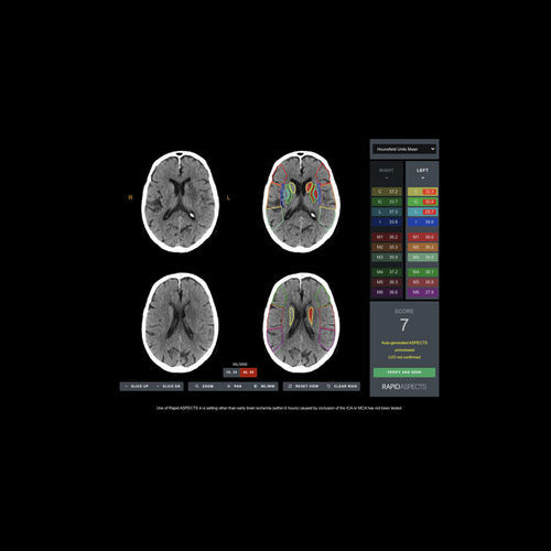Software per diagnosi di ictus - ASPECTS - RapidAI - di acquisizione ...