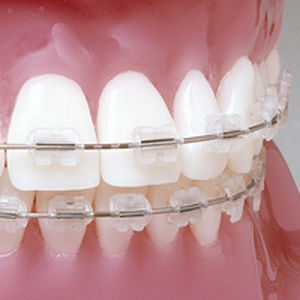 Bracket ortodontici estetico - Prism™ - G&H Orthodontics - trasparente