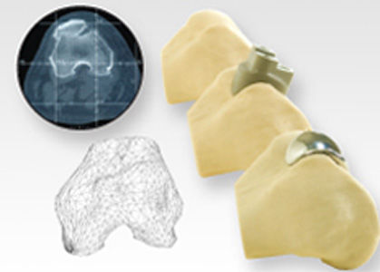 Protesi femoro-rotulea - KineMatch® - Kinamed